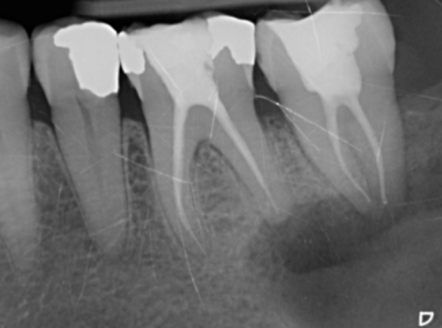 Radicular Cyst of Jaw: A Case Report